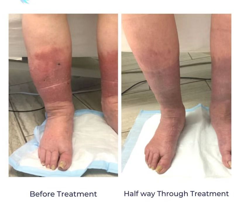 Do you know ？ How lymphedema caused people in horrible health issues